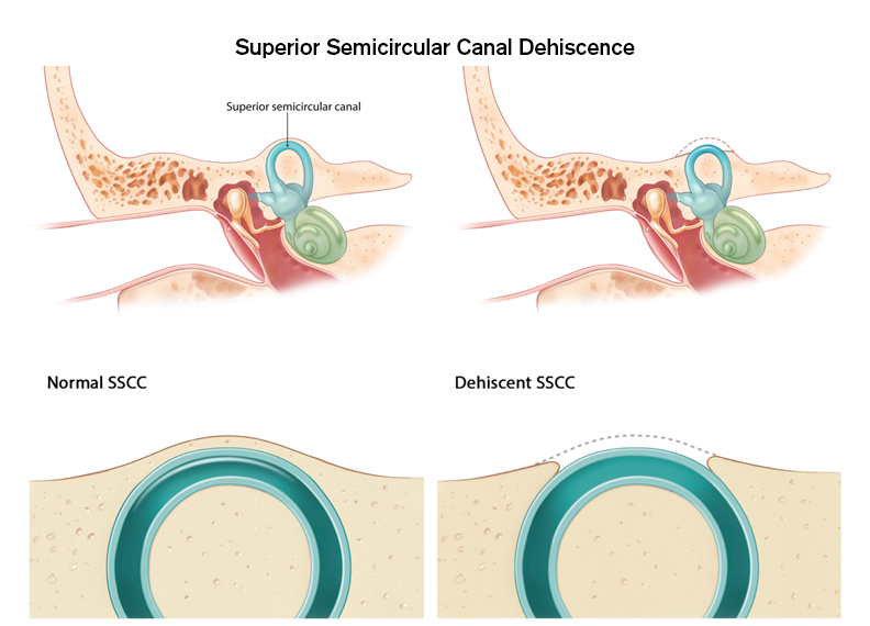 What Can Be Done For Vestibular Disorders?